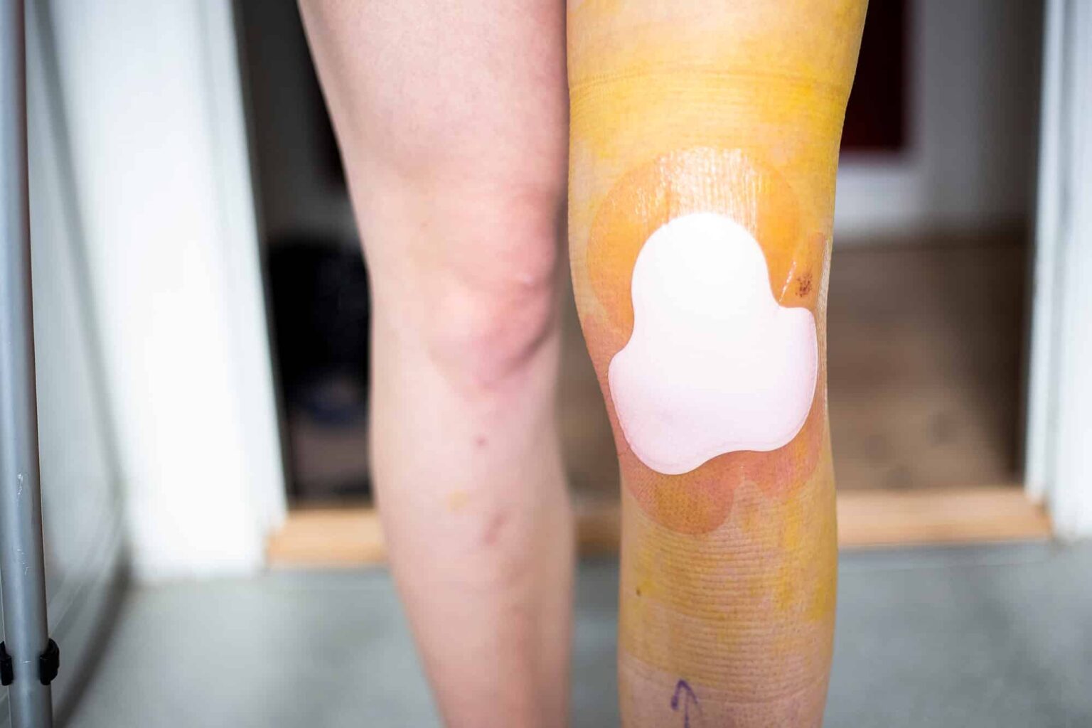 Guide To Knee Arthroscopy in Singapore - Orthocare SG