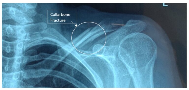 Clavicle Fractures Treatment in Singapore - Orthocare SG